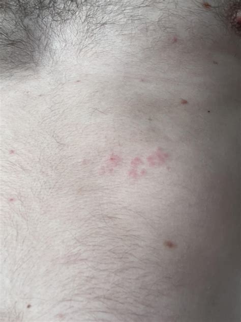 Shingles Bug Bite Cant See A Dermatologist Until Thursday Any