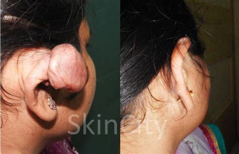 How To Get Rid Of Old Scars