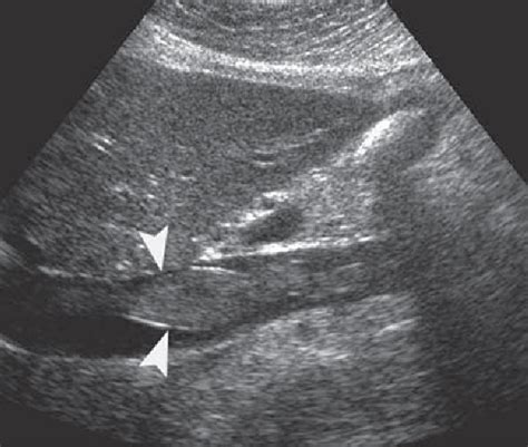 Intravenous Leiomyomatosis Semantic Scholar