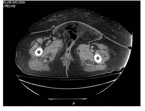 Vulvar Necrotizing Soft Tissue Infection A Review Of A Multi Disciplinary Surgical Emergency