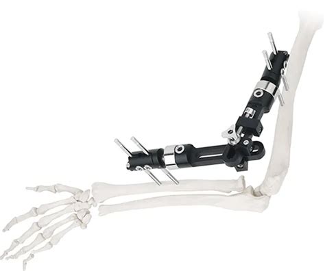 External Fixation Fixator At Proximal Femoral Fracture External