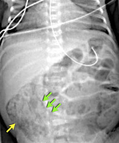 The Radiology Assistant Acute Abdomen In Neonates
