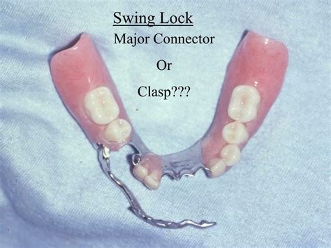 Types Of Clasps In Removable Partial Denture At Sara Miller Blog