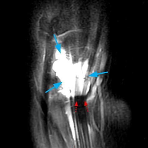 Stenosing Tenosynovitis Of The 4th Extensor Compartment Radsource