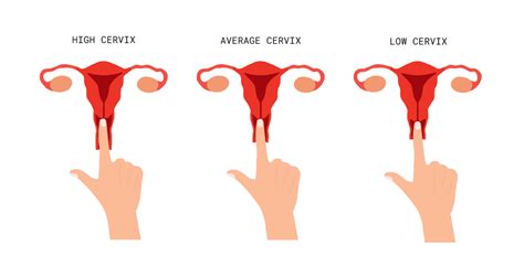 High Vs Low Cervix