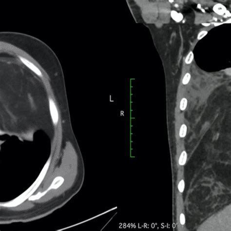 Contrast Ct Of The Chest Shows Well Defined Fat Density Mass Occupying