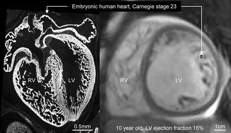 Left Ventricular Non Compaction Cardiomyopathy How Many Needles In The
