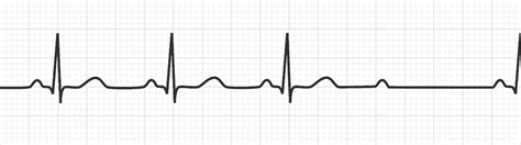 Atrioventricular Av Block Bradyarrhythmias Medschool