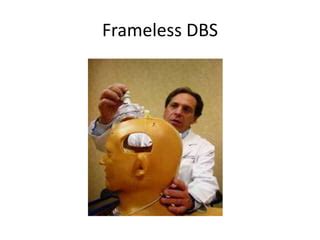 Frameless Dbs For Movements Disorders Pptx