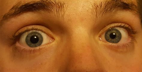 Friend Has Slightly Different Sized Pupils R Mildlyinteresting