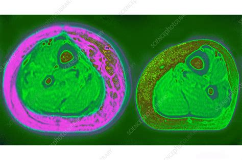 Edema CT Scan Stock Image C030 6288 Science Photo Library