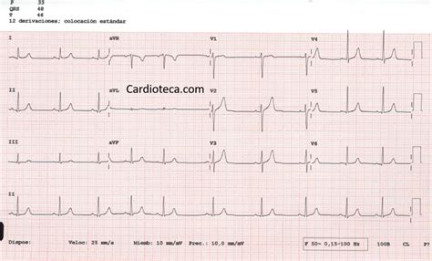 Curso Ecg Arritmia Respiratoria