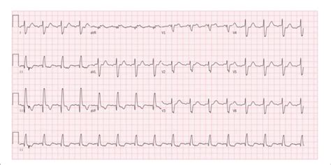 Figure E Patients Ecg After This Admission Ectopic Rhythm Heart Rate
