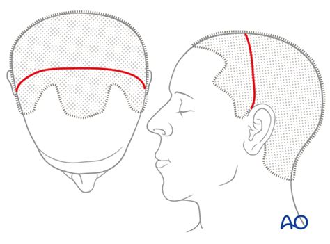 Coronal Approach Coronal Approach
