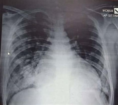 Cxr Showing Cardiomegaly With Bilateral Lower Zone Heterogenous Opacity Download Scientific