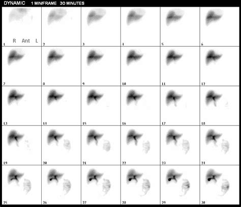 Ejection Fraction Hida Scan At Benjamin Ferguson Blog