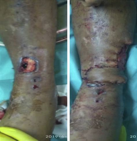 Rotational Flap Procedure Carried Out In 8 Cases Download Scientific Diagram