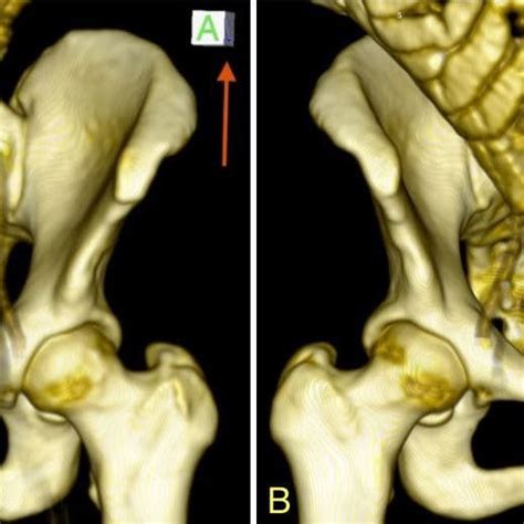 A A Pelvis Three Dimensional Reconstruction Red Arrow Shows Download Scientific Diagram