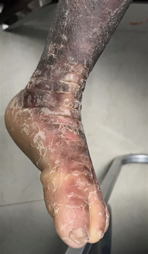 Erythrokeratodermia Variabilis Erythrokeratoderma Variabilis In A