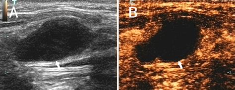 Lltrasound Evaluation Of Lymph Node Size And Necrosis Rate Idr