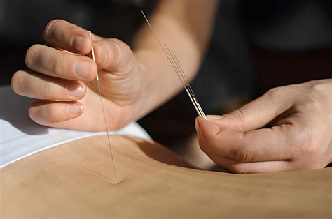Cupping Vs Acupuncture Which Should You Book First Loong Wellness