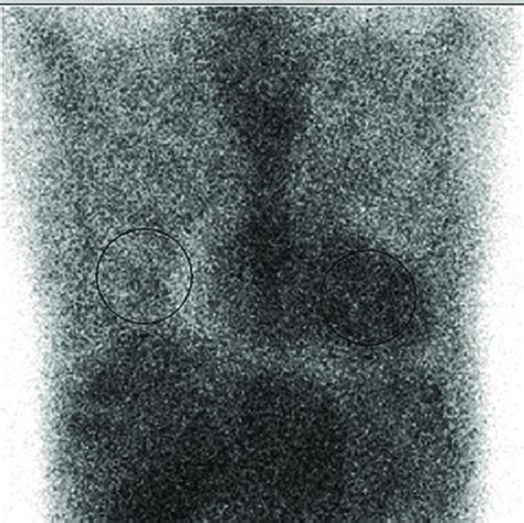 Tc 99m Pyp Scintigraphy Intensive Tc 99m Pyp Uptake On Nuclear Download Scientific Diagram