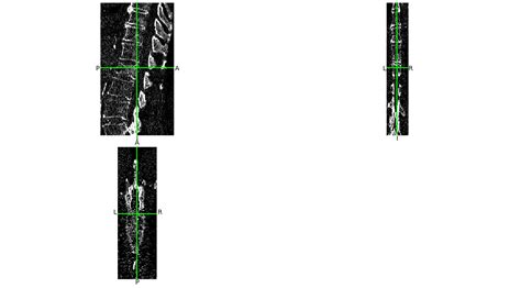 几种读nii图像方法的轴序比较nibabel读取nii转numpy后数据排列方式 Csdn博客