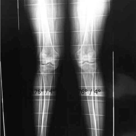 Deformidad Angular De Huesos Largos Genu Valgo Download Scientific Diagram