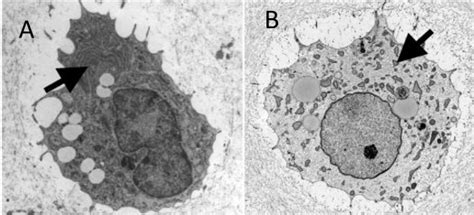 Dark A And Light B Chondrocytes With The Transmission Electron