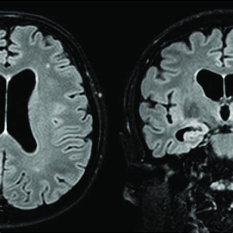 Characteristics Of Neurosyphilitic Patients Presenting Status
