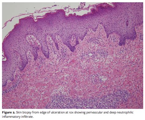 Pyoderma Gangrenosum Of The Scalp A Rare Clinical Variant