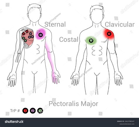 Myofascial Trigger Point Pectoralis Major Sternalcostal Stock