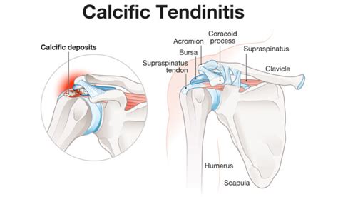 Shoulder Calcification