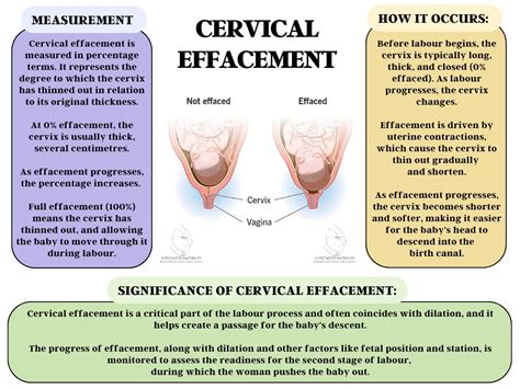 Cervical Effacement Also Known As Cervical Thinning Is Another