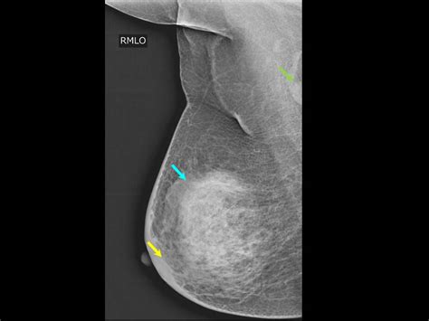 Enlarged Lymph Node In Breast On Mammogram Sale