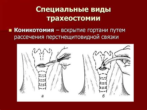 Трахеостомия - презентация онлайн