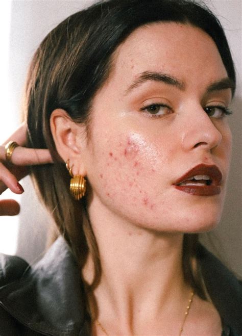 Meet Sofia Grahn The Swedish Influencer Who Wants Us To Embrace Acne
