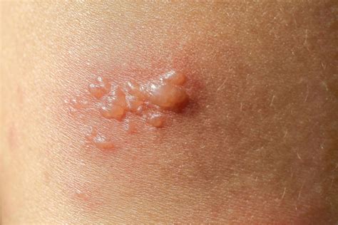 50 Facts About Bullous Pemphigoid