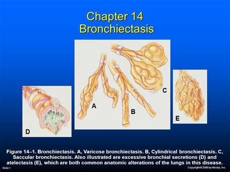 Types Of Bronchiectasis