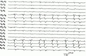 EEG Test Cost EEG Recording EEG Test Centre In Ahmedabad Epilepsy Diagnosis