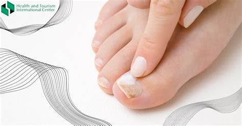 How To Avoid Nail Fungus Hti Centers Medical Tourism Center