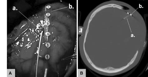A Intra Operative Photograph Showing A Intraparenchymal Placement Of Download Scientific