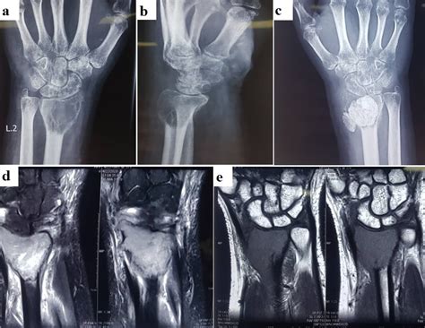 Giant Cell Tumor Of Distal Radius En Bloc Resection With Allograft Reconstruction A Case Report
