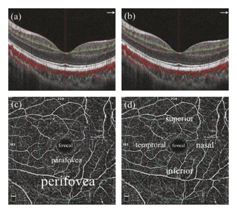 Pictorial Representation Of The Macular Capillary Plexus A B