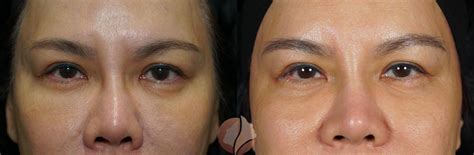 Before And After Lid Retraction Repair