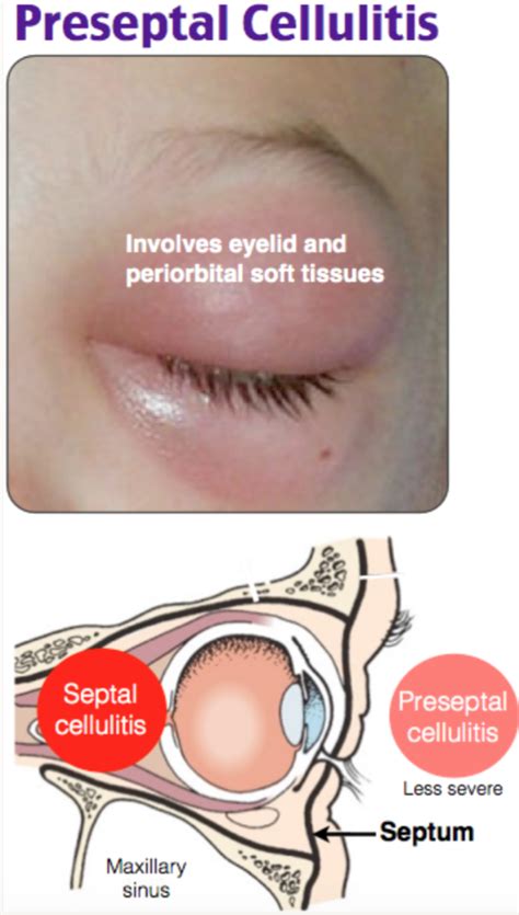 Em3am Periorbital Cellulitis Emdocs