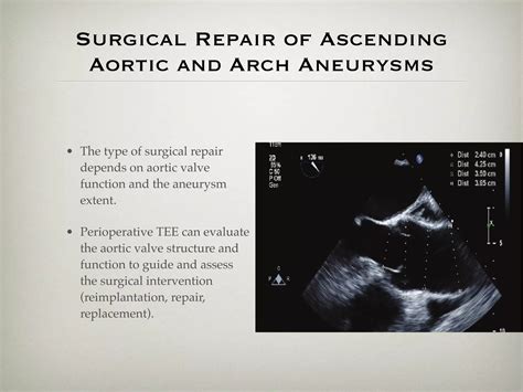 Aortic Aneurysms And Dissection 2016 Pdf