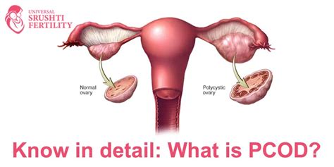 What Is Pcod Pcod Treatment In Vijayawada Pcod Centre Vijayawada