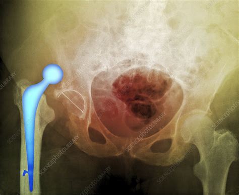 Dislocated Hip Prosthesis X Ray Stock Image C Science