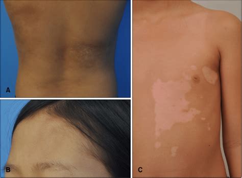A Two Circumscribed Morphea On The Right And Left Sides Of The Back
